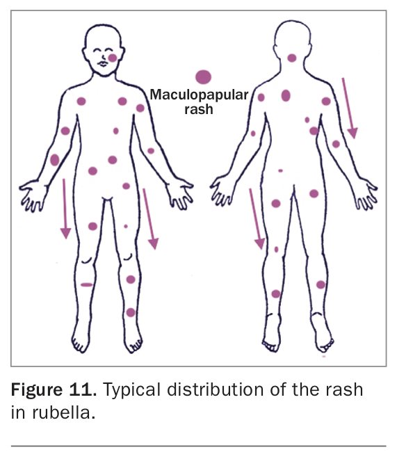 Viral exanthems: unravelling viral rashes | Medicine Today Viral exanthems: unravelling viral rashes | Medicine Today
